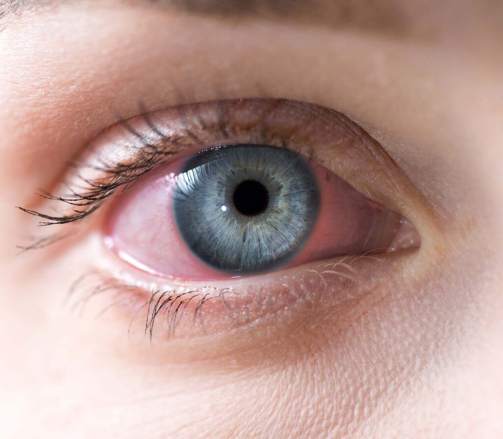 Diseases of the cornea Tampa | Newsom Eye | Sebring